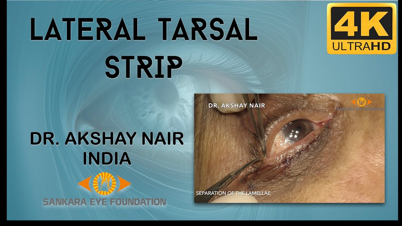 Lateral Tarsal Strip Surgery for Lower lid Entropion - Dr Akshay Nair ...