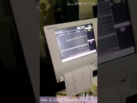 Non Stress Test (NST) - Normal and with Constructions - YouTube