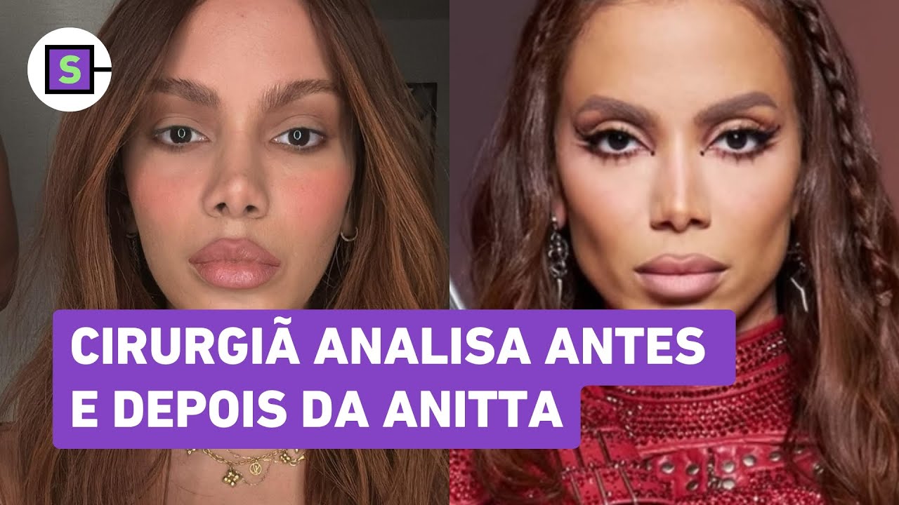 Anitta antes e depois: Cirurgiã dentista fala possíveis procedimentos ...