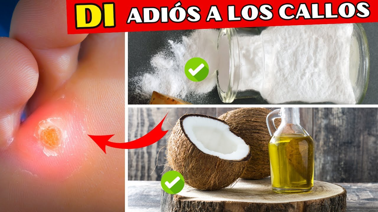 Mi Podólogo Me enseñó Cómo CURAR los CALLOS de los Pies | Remedios ...