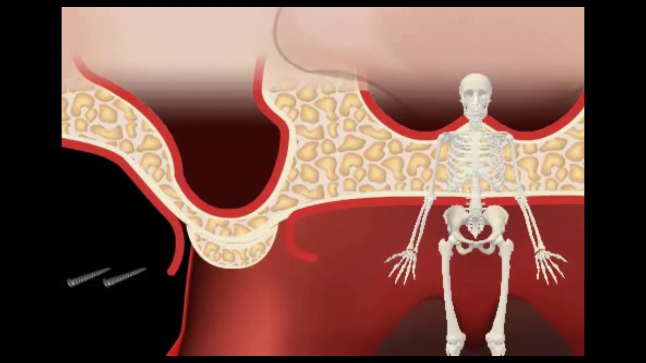 Atrofia procesului alveolar in osul maxilar - YouTube