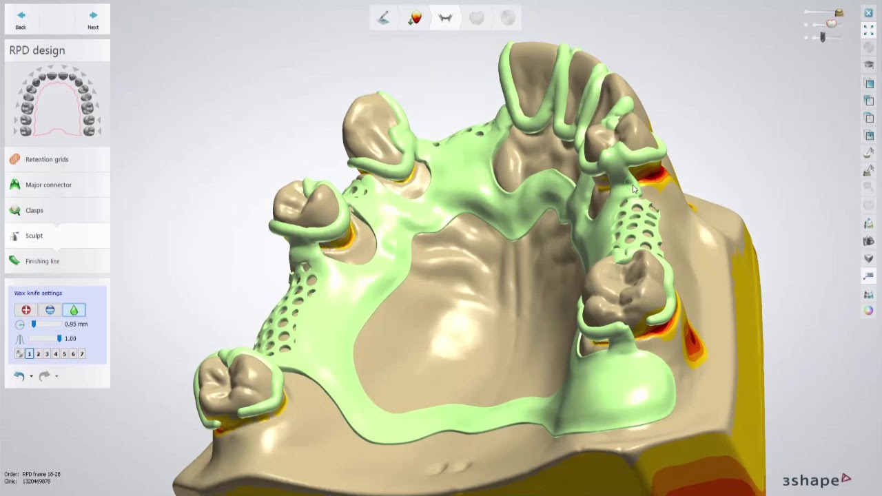 245 - Upper RPD Class II mod 4 - YouTube