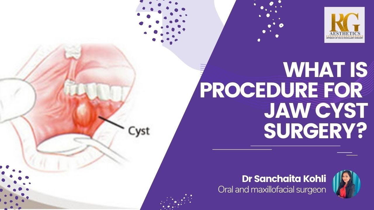 What is the Procedure For Jaw Cyst Surgery? | Dr Sanchaita Kohli | Face ...