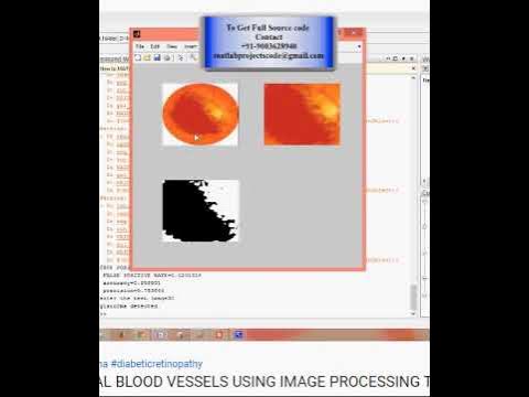 ANALYSIS OF RETINAL BLOOD VESSELS -IMAGE PROCESSING TECHNIQUES MATLAB-MATLAB ASSIGNMENTS PROJECT ...