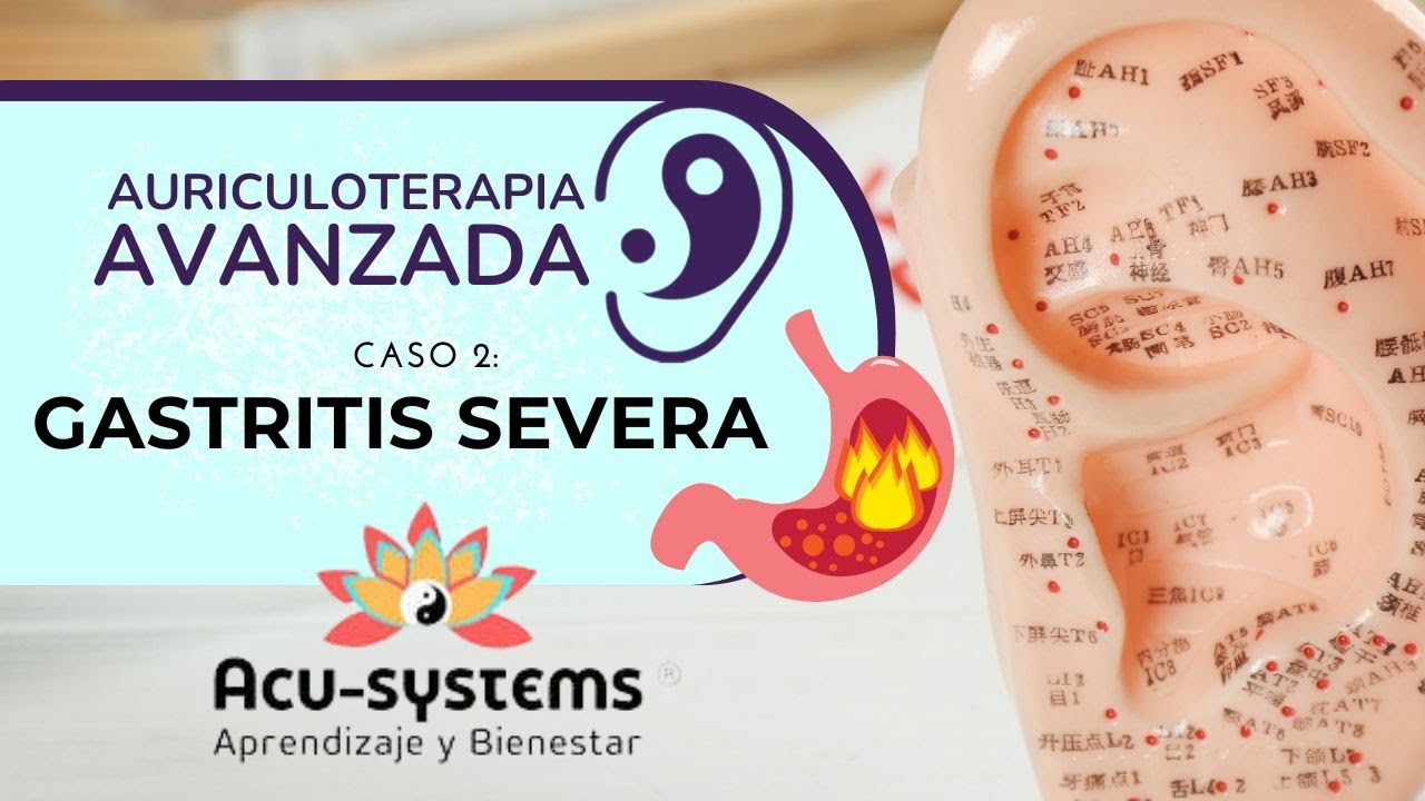 GASTRITIS SEVERA EN AURICULOTERAPIA AVANZADA. ANALISIS EN DIAGNOSTICO Y ...