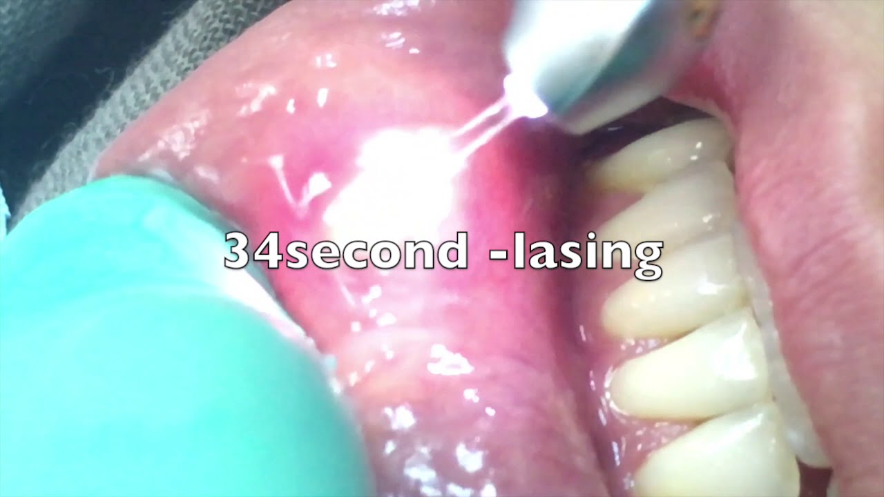 Er,Cr:YSGG laser for treatment of Major Aphthous Ulcer - YouTube