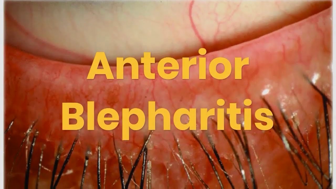 Anterior Blepharitis - YouTube