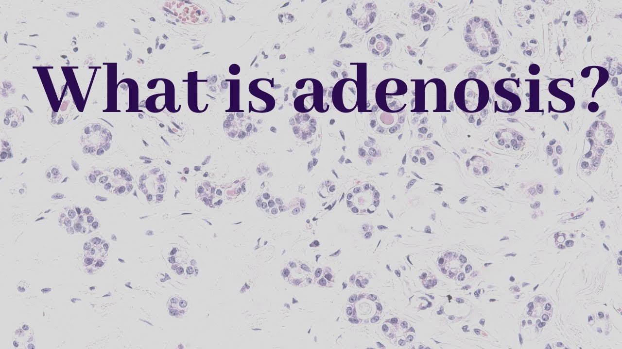 What is Adenosis? - Pathology mini tutorial - YouTube