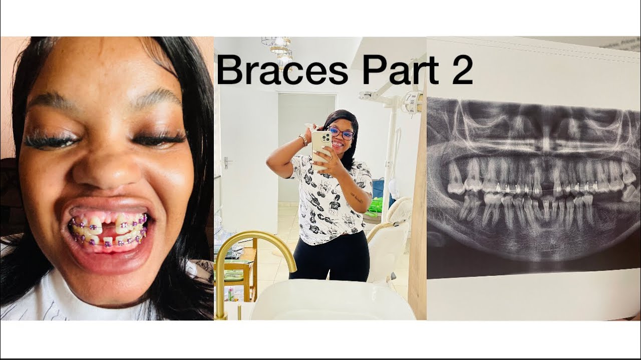 Braces Part 2|| Closing Big Gaps|| Dental X-ray| South African YouTuber ...