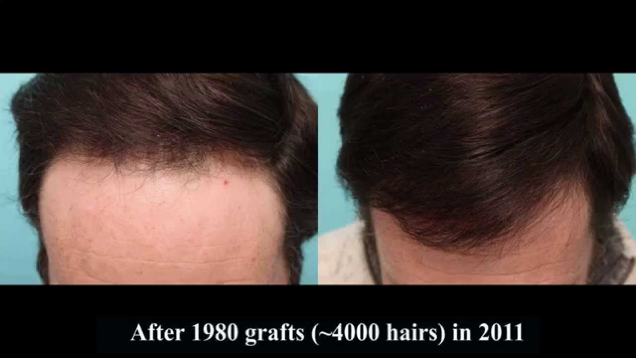 RESULT: Hair Transplant Hairline Restoration Kevin Andrews at Farjo ...
