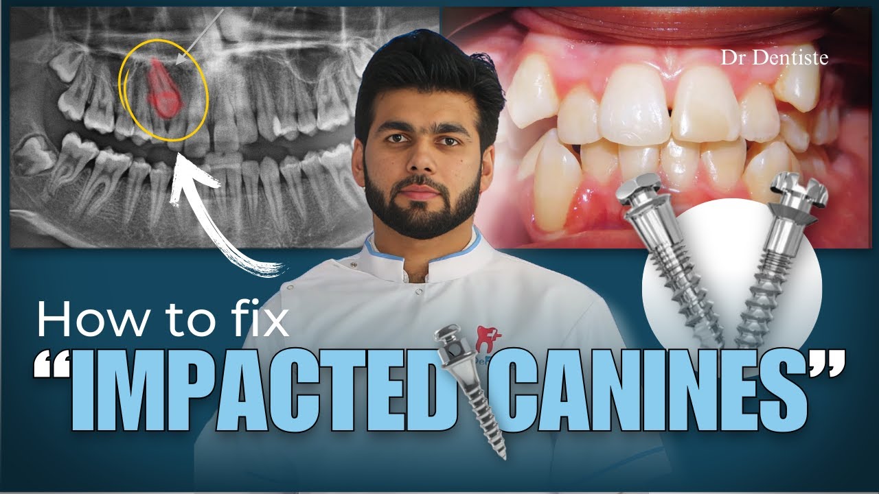 Impacted Canine Treatment Using TADs: Step-by-Step Orthodontic Guide ...