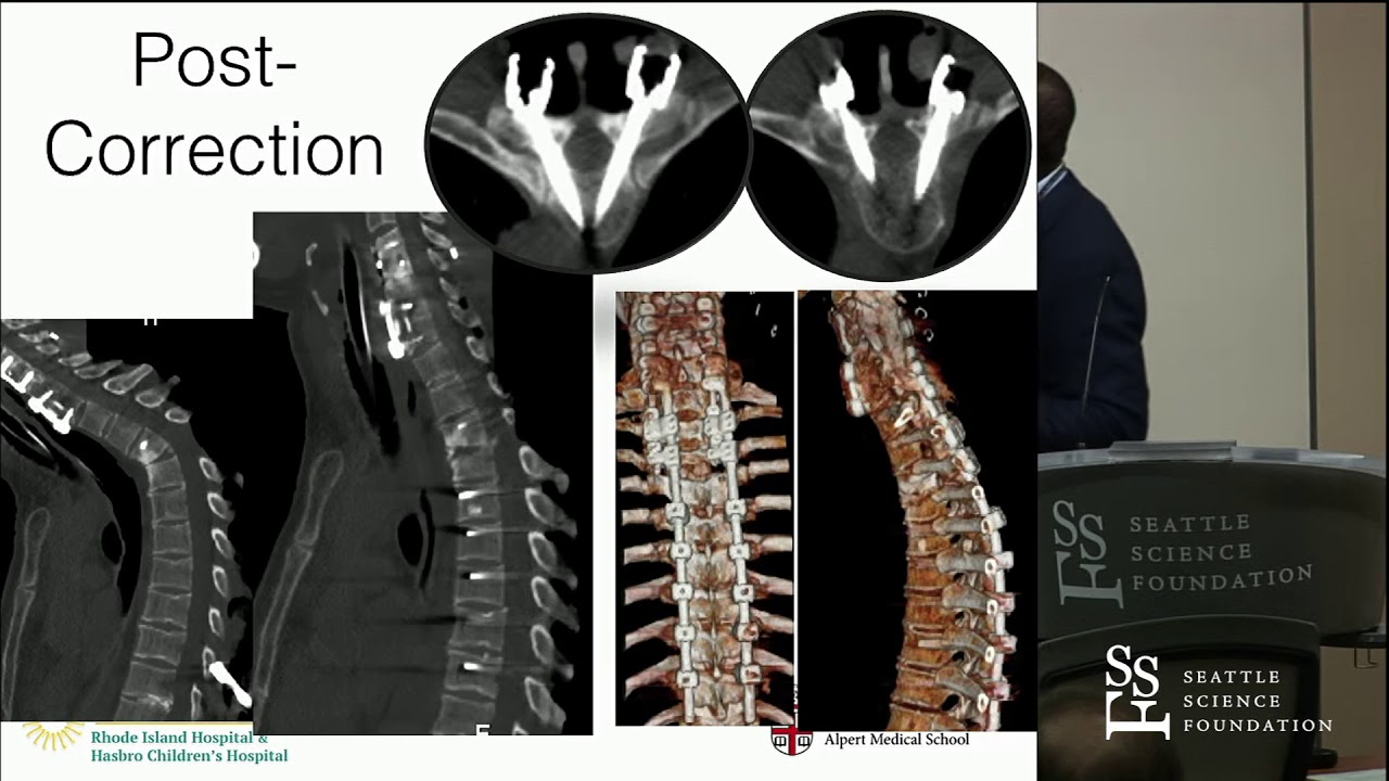 Spinal Navigation: The Brown Neurosurgery Experience - Adetokunbo ...