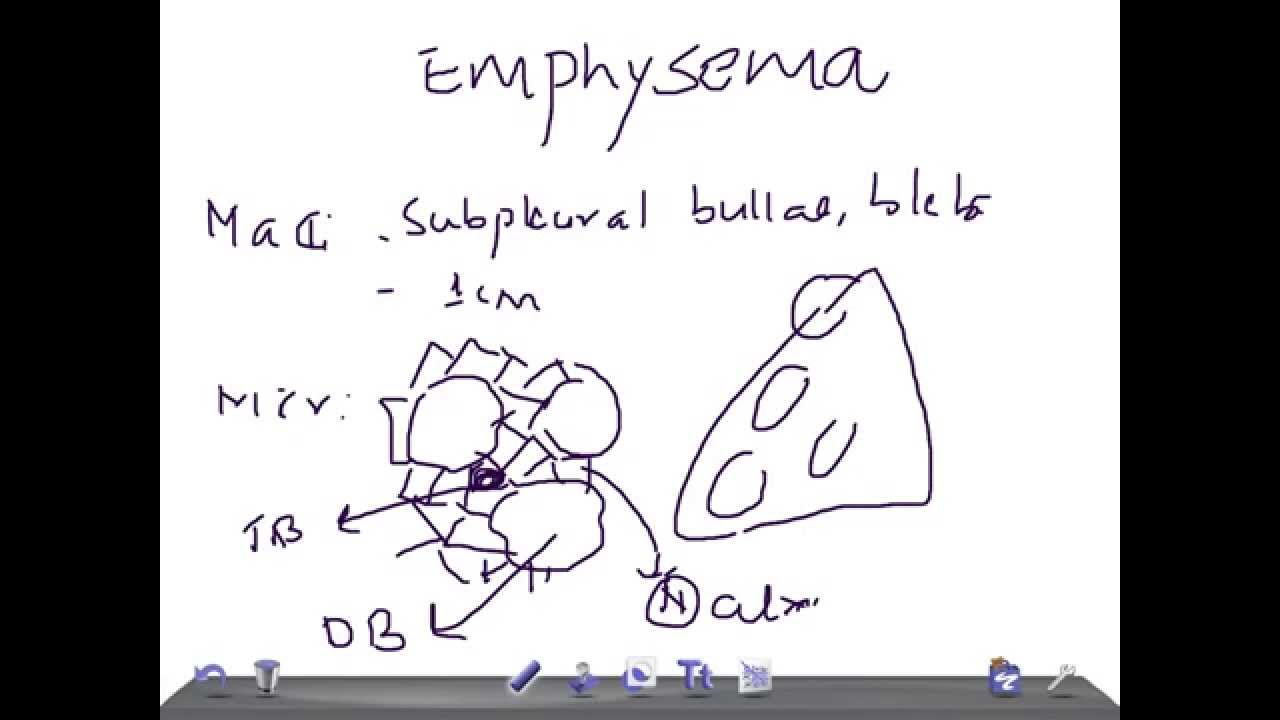 QUICK PATHOLOGY: Emphysema of Lung ( Macroscopic & Microscopic) - YouTube