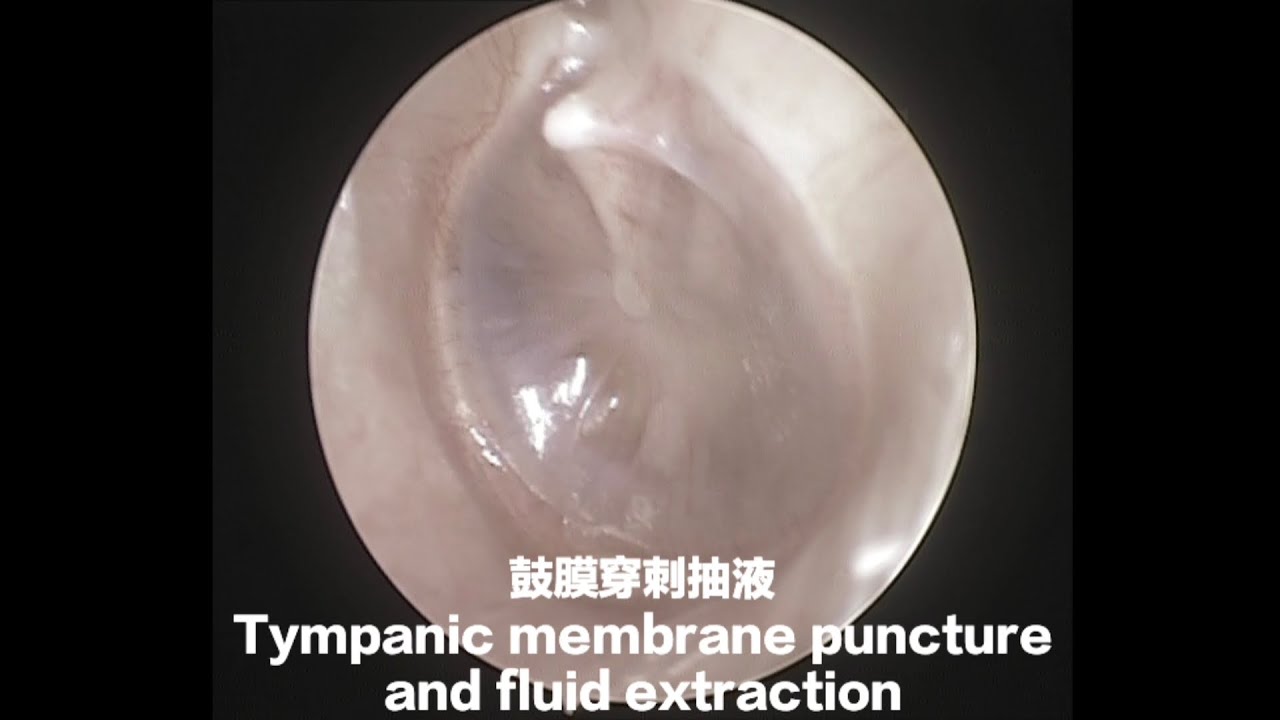 （去色版）鼓膜穿刺抽液Tympanic membrane puncture and fluid extraction - YouTube