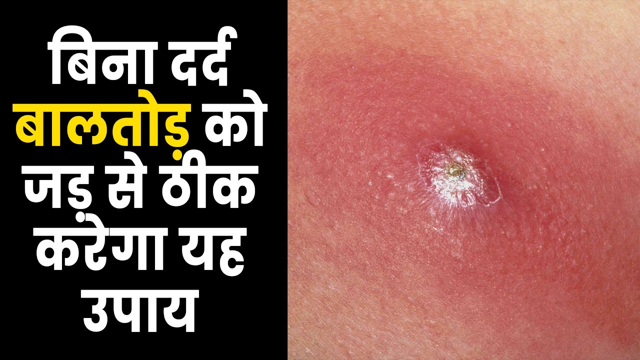 बिना दर्द बालतोड़ जड़ से ठीक करेगा यह 4 उपाय, कोई 1 उपाय कर लो तुरंत ...