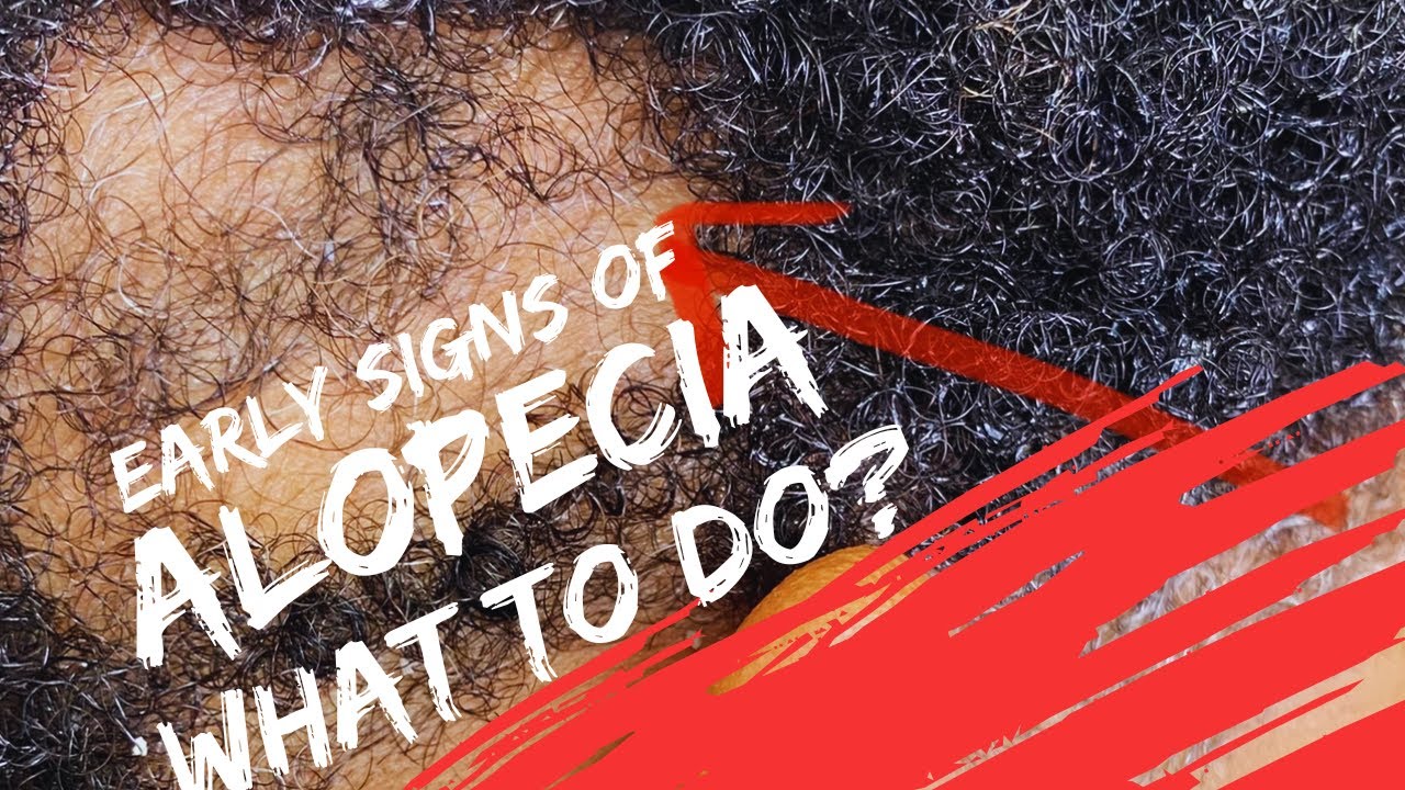 Early signs of Alopecia - YouTube