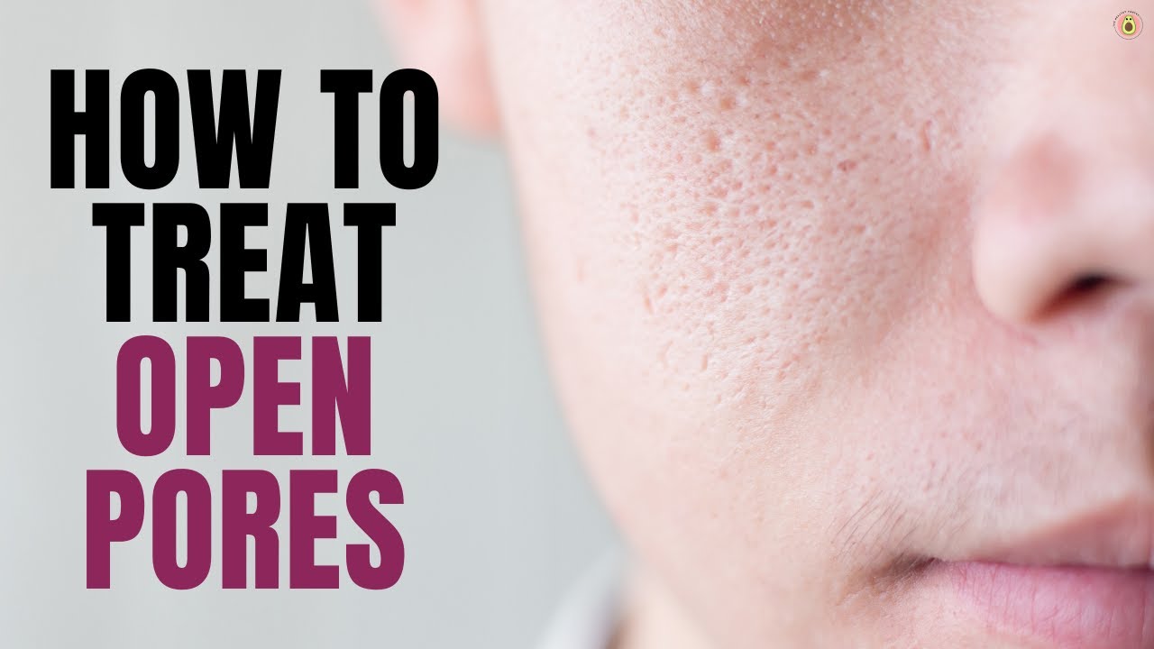 How to Treat OPEN PORES | Enlarged Pores - Causes & Treatment! - YouTube