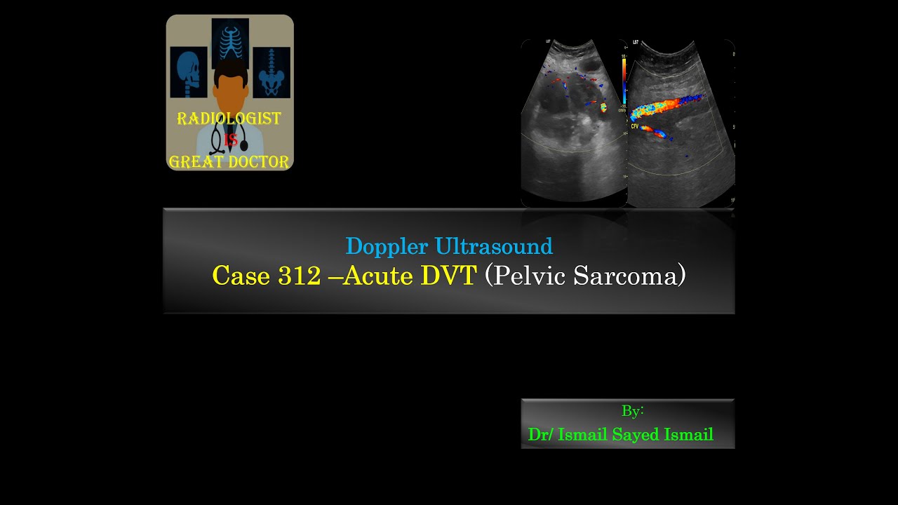 Ultrasound Case 312 - Acute Iliofemoral DVT 2ry to Pelvic Sarcoma - YouTube