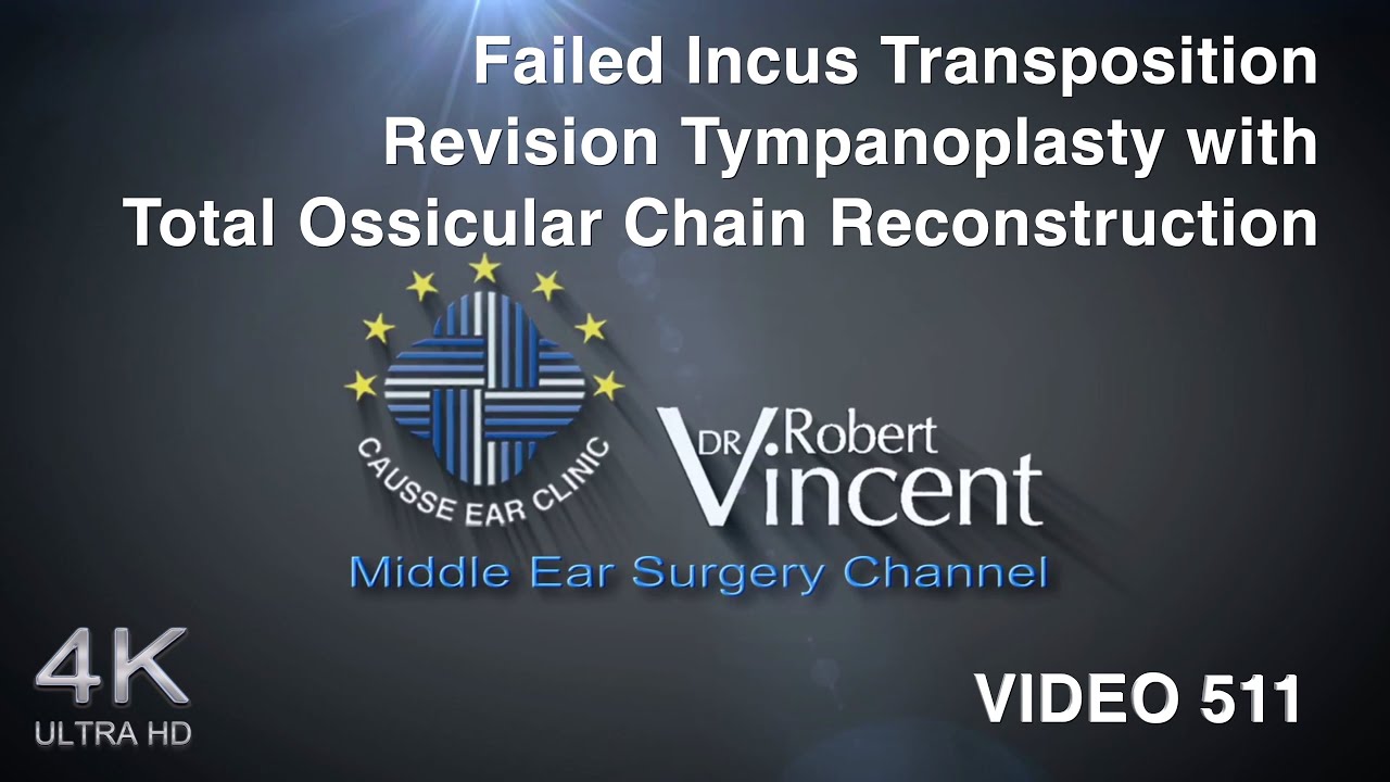 Failed Incus Transposition: Revision Tympanoplasty with Total Ossicular ...