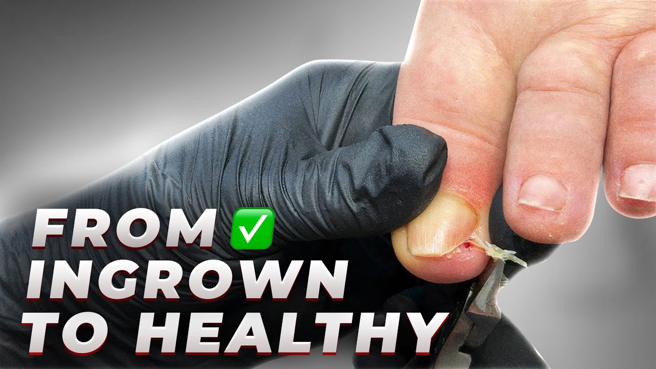 Ingrown Toenail Transformation – Fixed in 2 Months with Titanium Thread ...