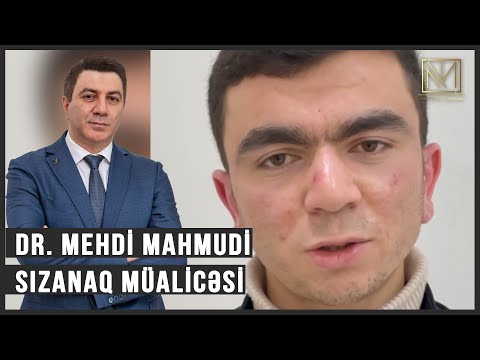 Dermatoloq | Deri Hekimi | Dr. Mehdi Mahmudi Sızanaq Müalicəsi