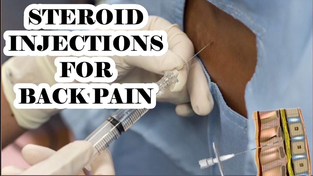 Should You Have Steroid Injection For Back Pain? - YouTube