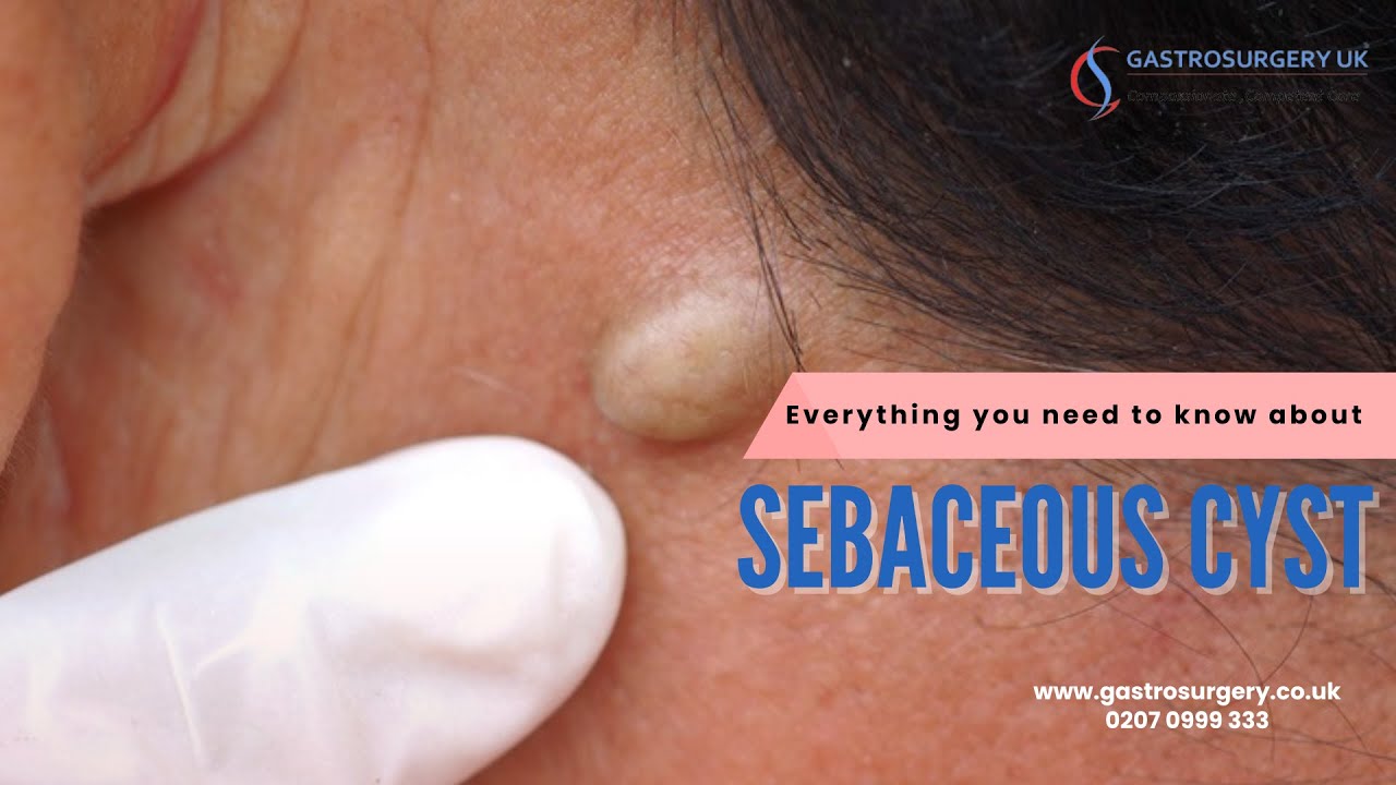 What is a Sebaceous Cyst? Everything you need to know about sebaceous ...