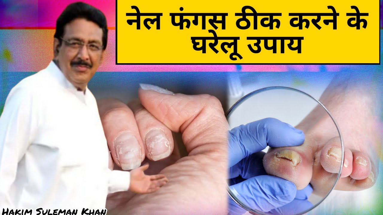 Nail fungus ko theek karne ka gharelu upay || By Hakim Suleman Khan ...