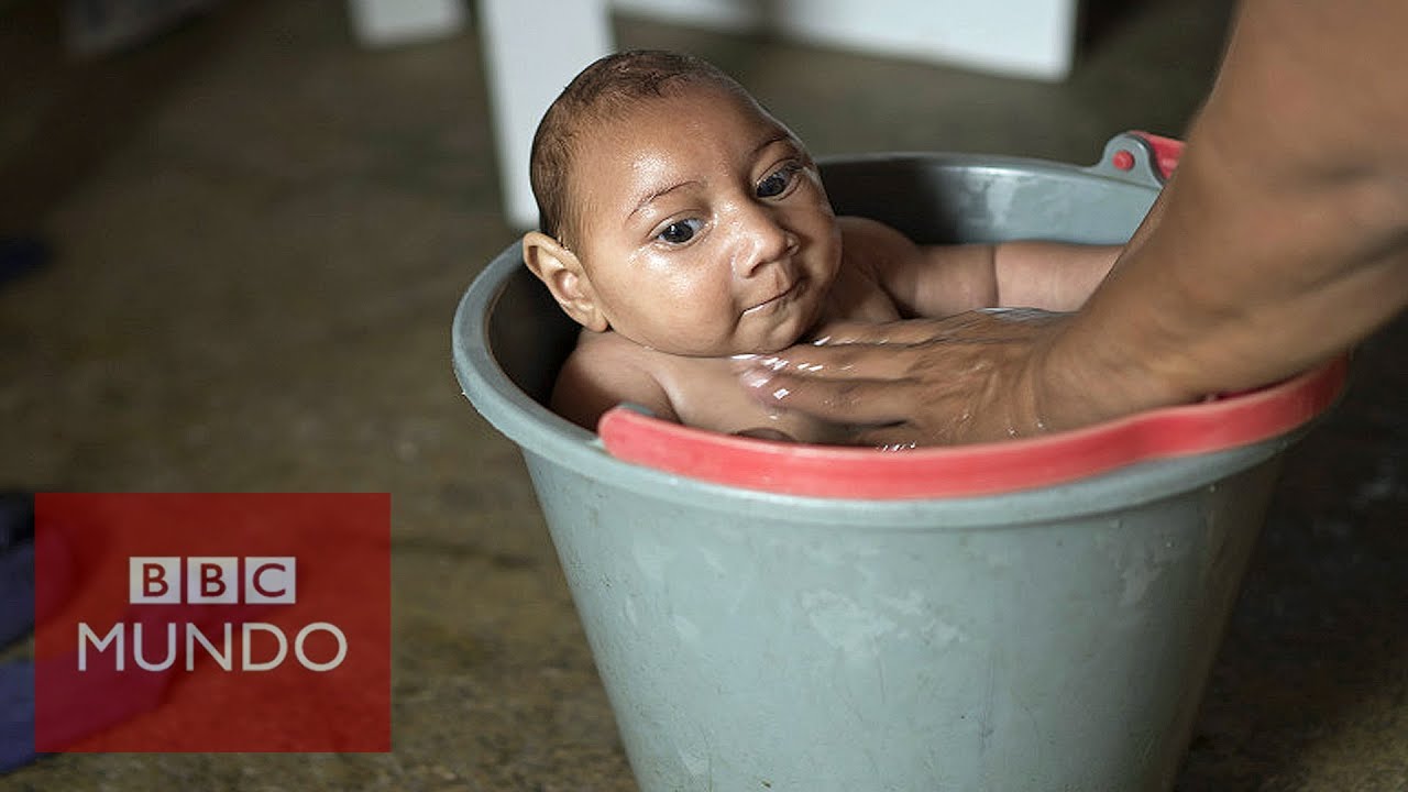 Zika: ¿Cómo es la vida del bebé con microcefalia de esta famosa foto ...