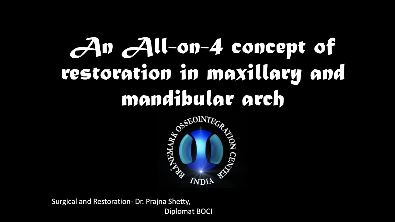 All-on-4 maxillary and mandibular implant supported restoration - YouTube