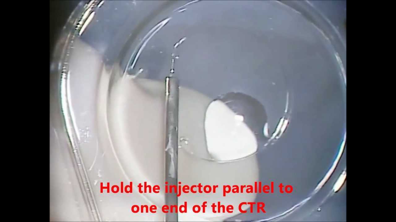 Ophtec CTR Insertion 2012, Jeffrey Whitman, MD - YouTube