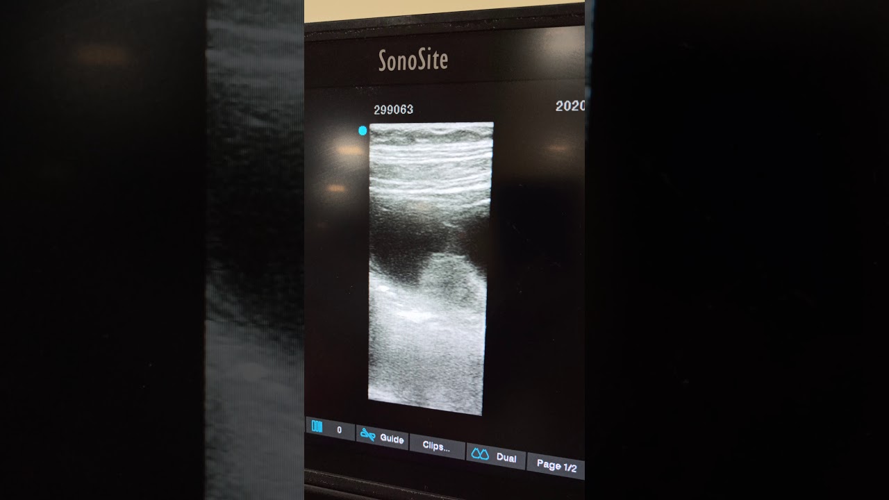 INTESTINAL OBSTRUCTION IN USG ABDOMEN - YouTube