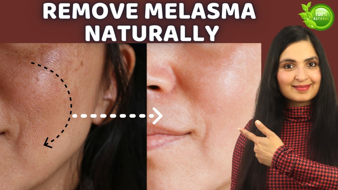 How To Remove Face Pigmentation Naturally, Get Rid of Dark Spots And ...