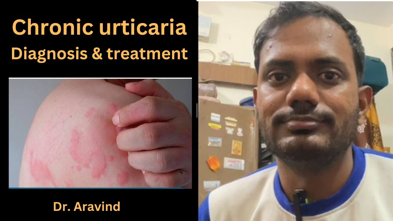 Chronic Urticaria (Hives): Causes, Symptoms, aggravating factors ...