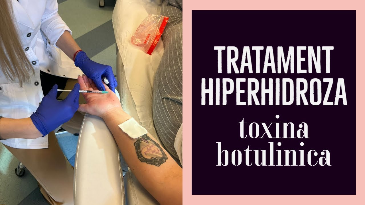 TRATAMENT HIPERHIDROZA: INJECTII CU TOXINA BOTULINICA - YouTube