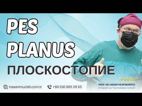Pes Planus - Плоскостопие | Prof. Dr. Hasan Hilmi Muratlı - Ortopedi ve Travmatoloji Uzmanı