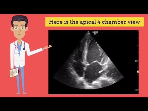 Coumadin ridge on focused echocardiogram I POCUS I Dr. Koratala - YouTube
