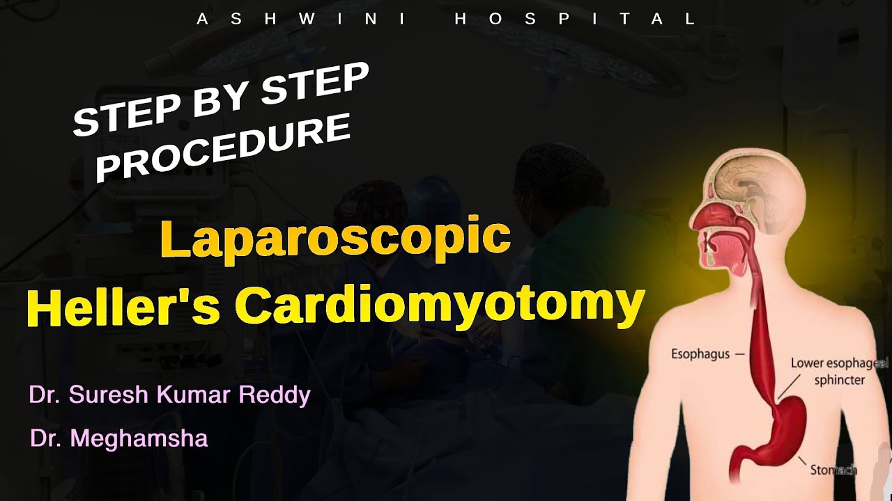 Step-by-Step Laparoscopic Heller’s Cardiomyotomy for Achalasia Cardia ...