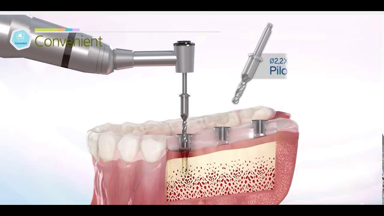 Simple Guide Surgery Animation - YouTube