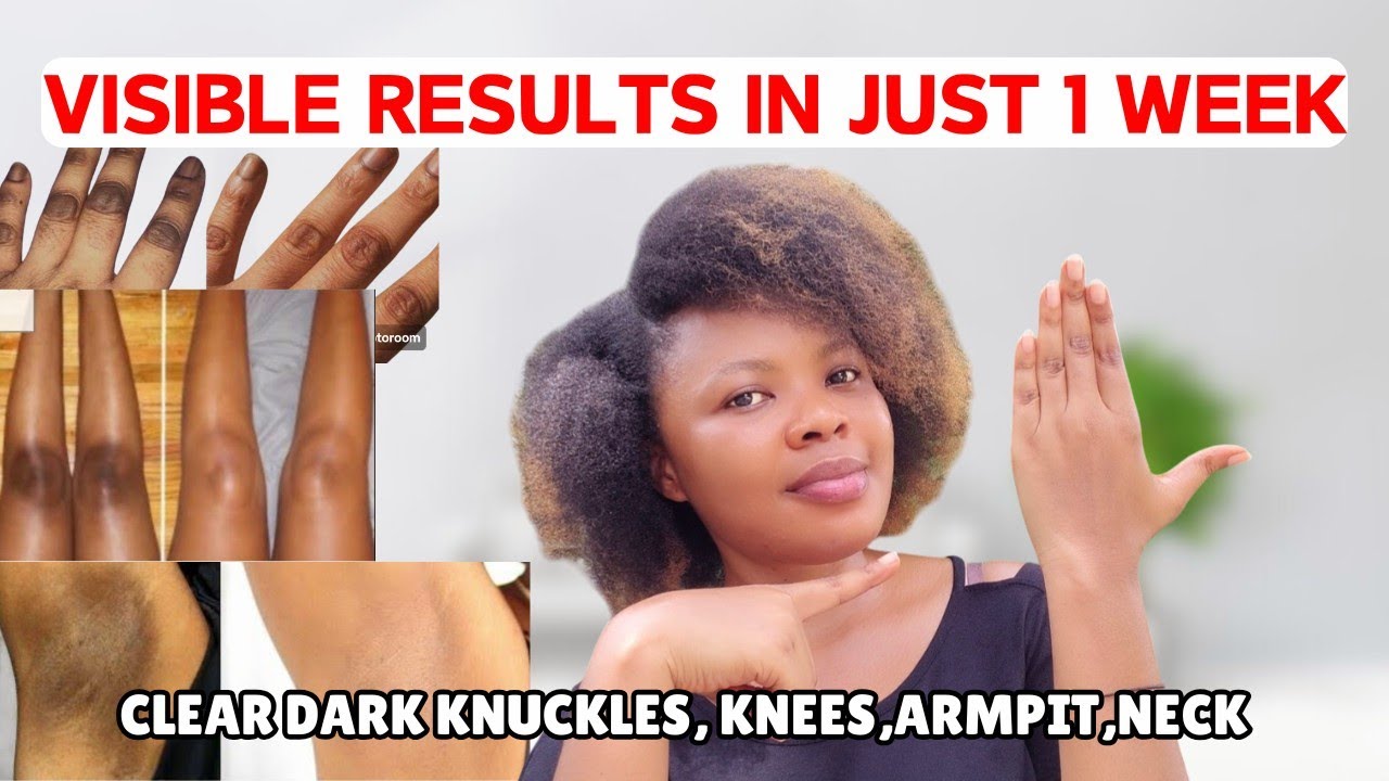 How To Clear dark knuckles,dark tighs, dark knees 💯 Results Assurance ...
