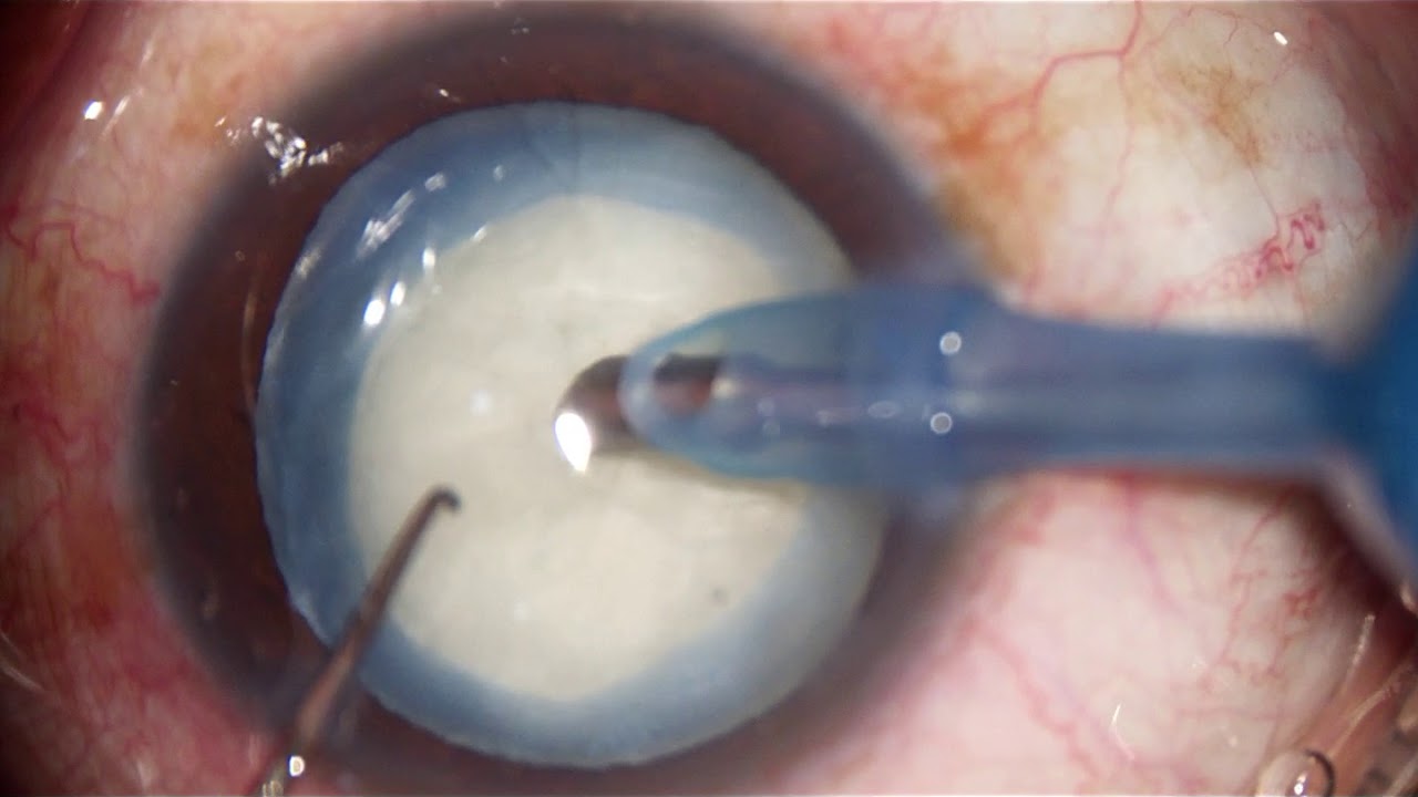 Phaco in white cataract & anterior capsular plaque - YouTube