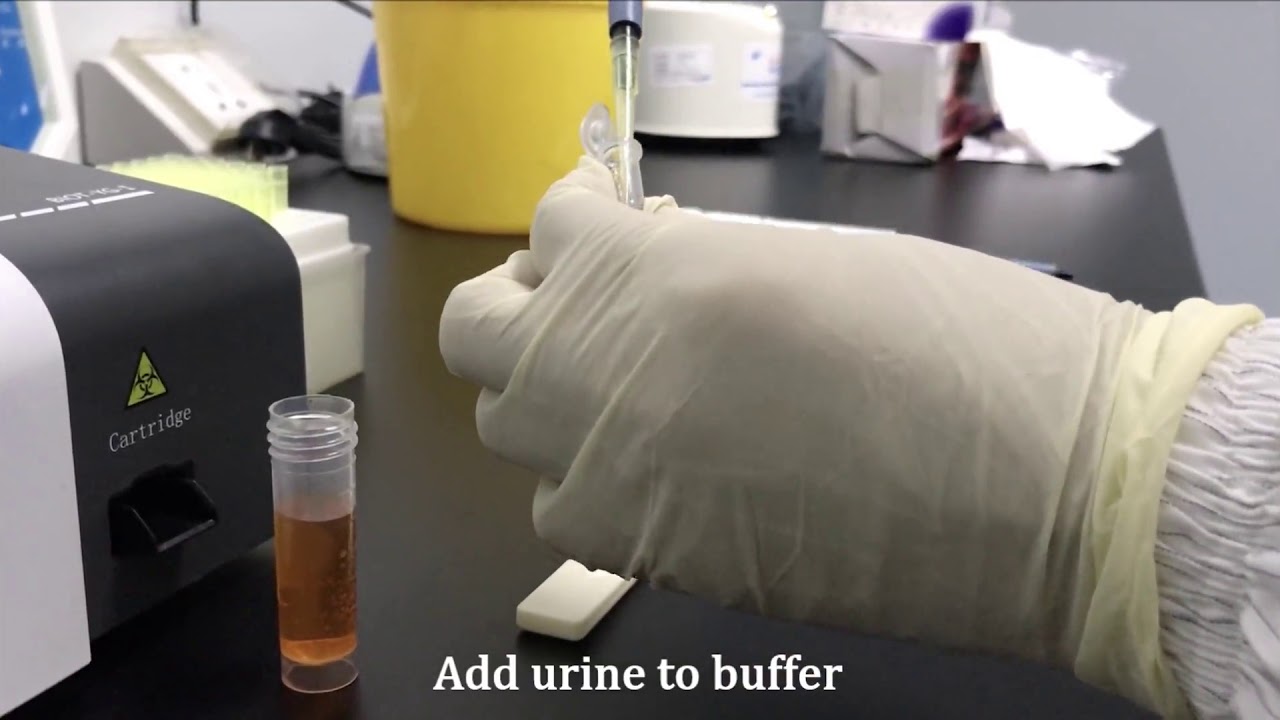 NGAL test kit for AKI markers - YouTube