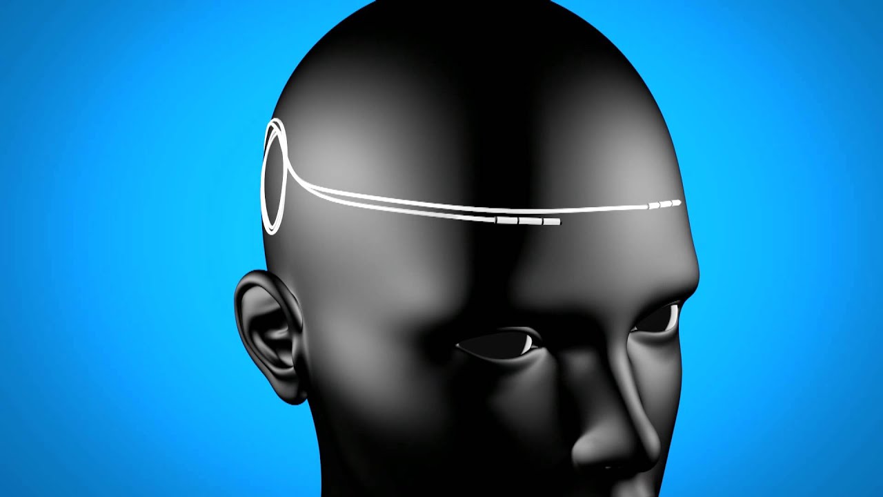 The Reed Procedure for Migraine & Headache Treatment Dallas Pain ...