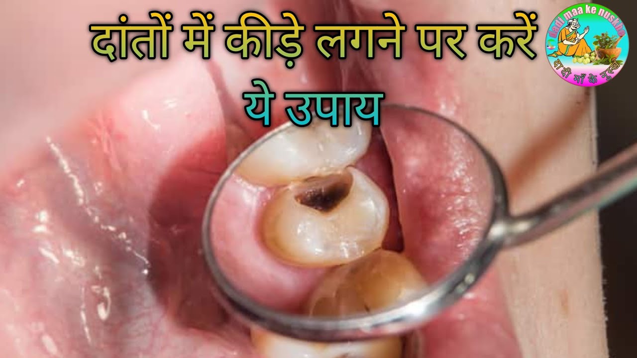 dant me kida lagna ka ilaj ,dant me kida lagna ke upay - YouTube