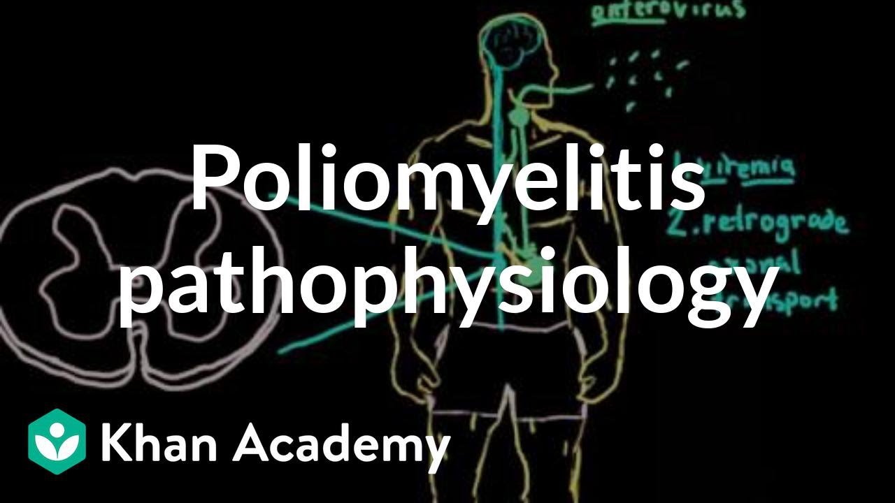 Poliomyelitis pathophysiology | Infectious diseases | NCLEX-RN | Khan ...