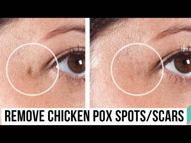 How To Get Rid Of Chicken Pox Scars Chickenpox Scar Removal NYC