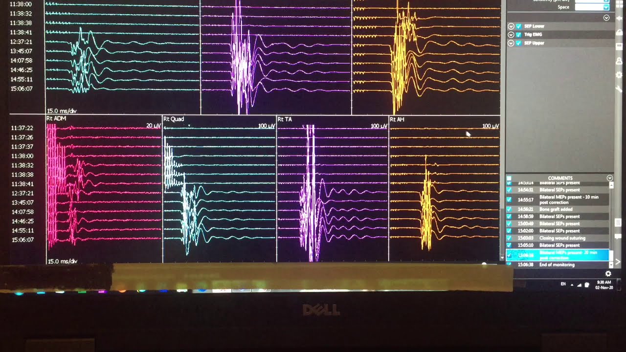 MEP changes due to muscle relaxant / Intraoperative Neurophysiological ...