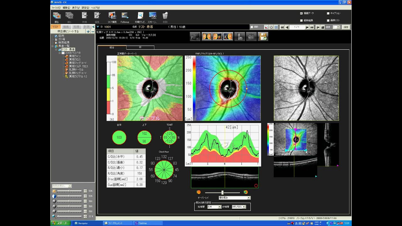 Nidek RS3000 Disc Map.avi - YouTube