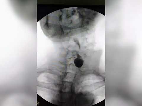 Divertículo de esofago, visto por fluoroscopia. - YouTube