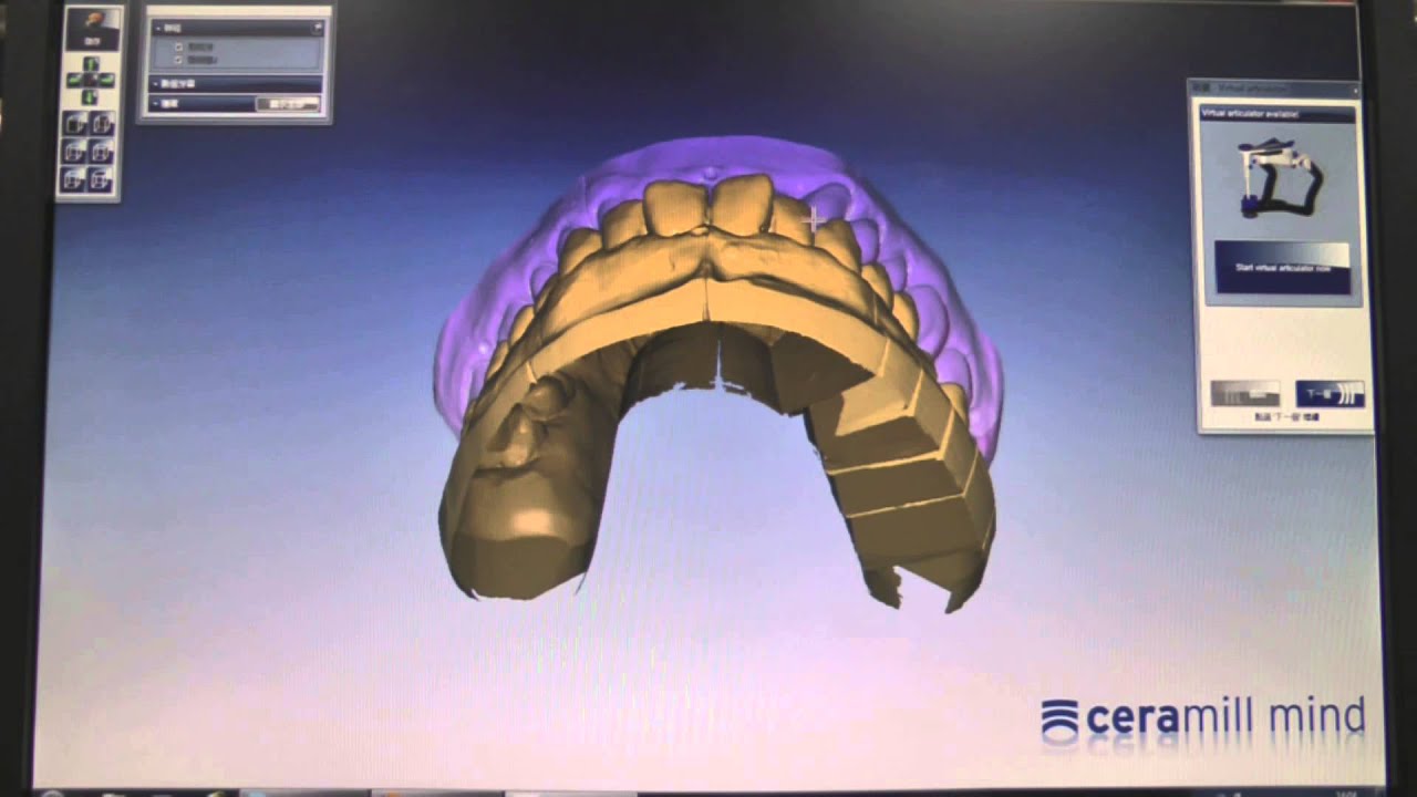 Ceramill MAP300 & MAP400掃描器的 Virtual Artex 虛擬調咬合功能 - YouTube